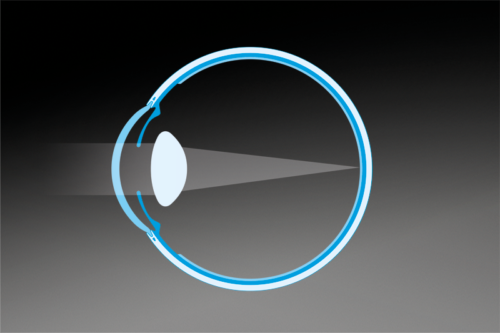 Haag-Streit LENSTAR Myopia - Gold Coast Ophthalmic Instruments, Inc.