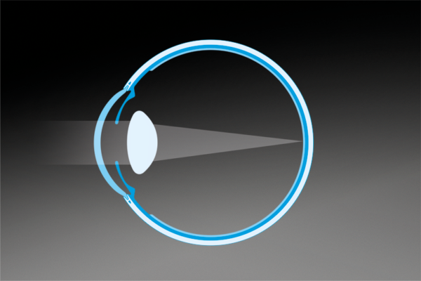 Haag-Streit LENSTAR Myopia - Gold Coast Ophthalmic Instruments, Inc.