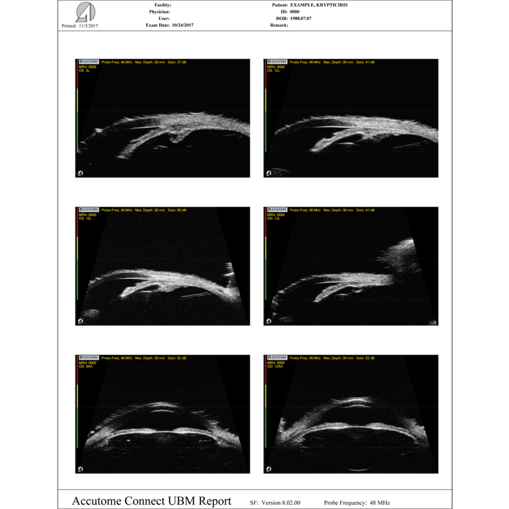 Keeler Accutome UBM Plus - Gold Coast Ophthalmic Instruments, Inc.